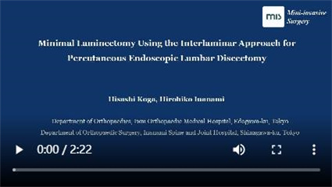 Minimal laminectomy using the interlaminar approach for percutaneous ...